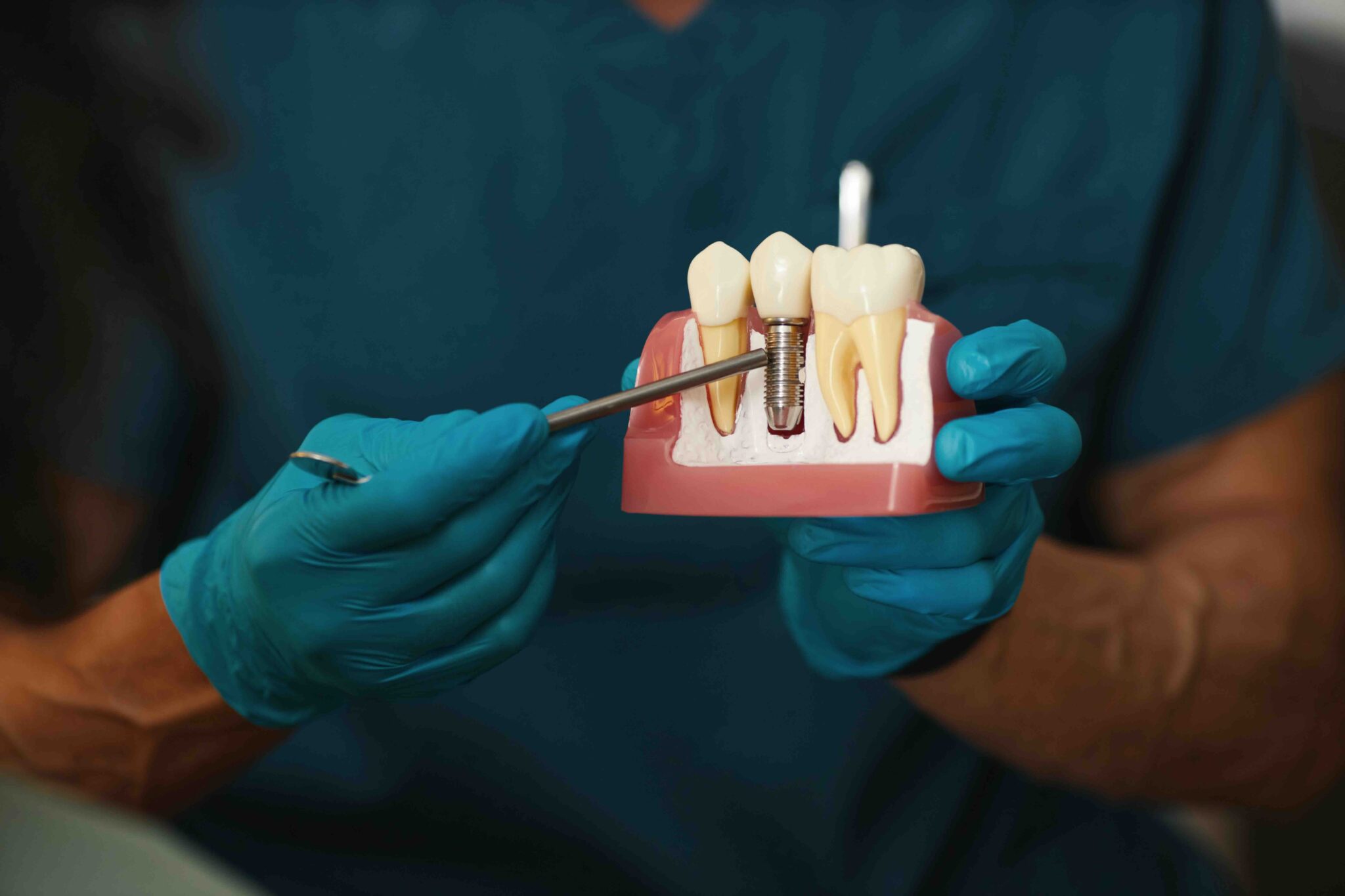 Quanto costa un impianto dentale?